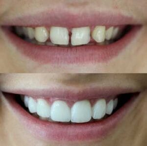 Porcelain Veneers Before After Lahore | Best Dental Clinic