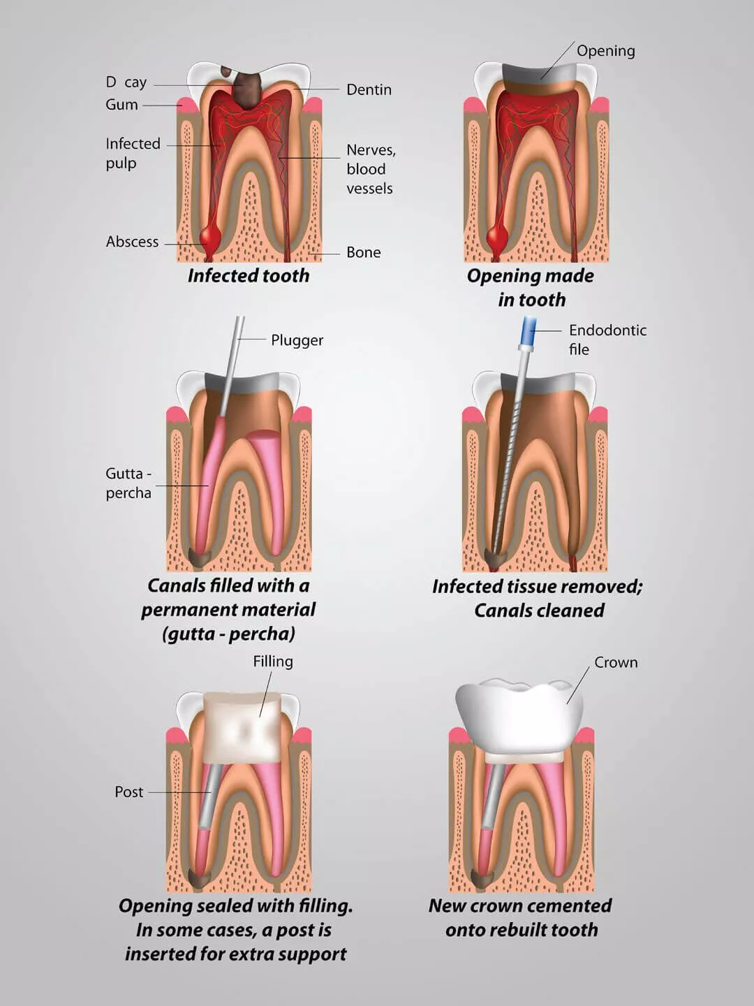 Professional Root Canal Treatment in Lahore | SmileOn Dentist